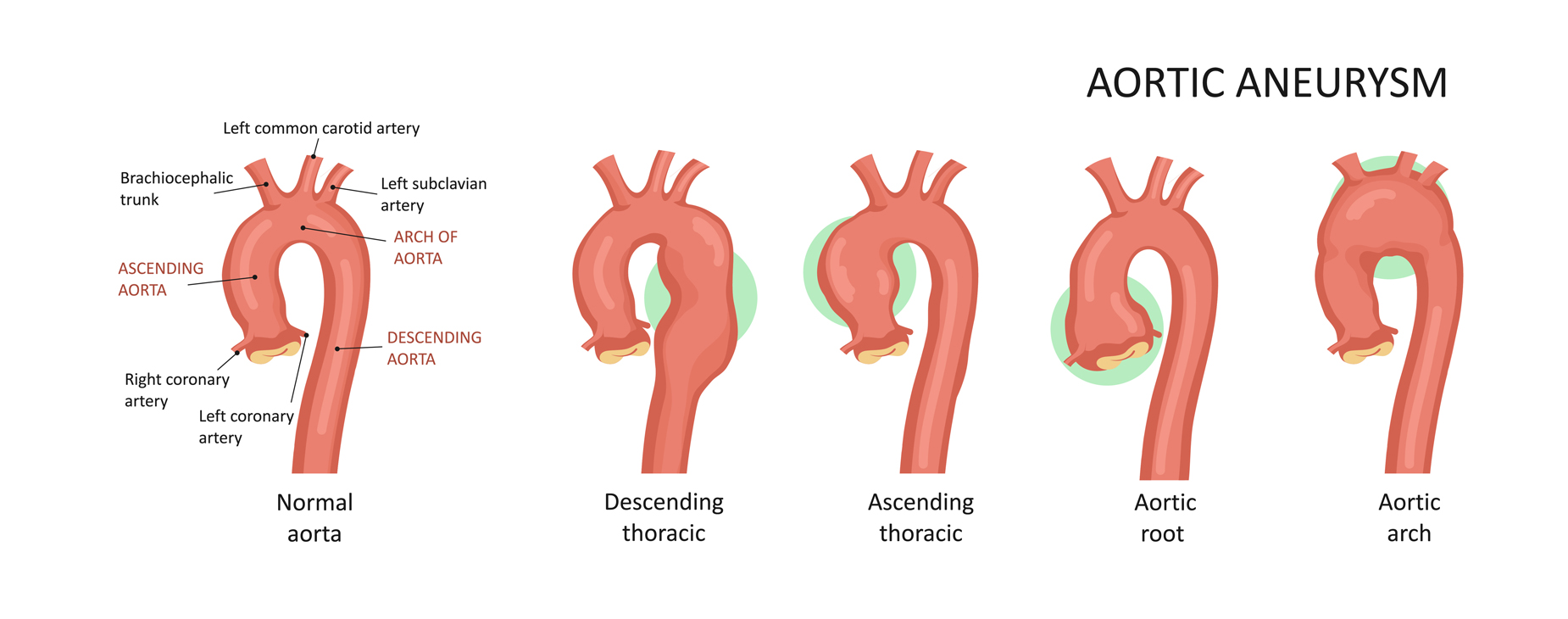 Aortic Surgery Adelaide Cardiothoracic